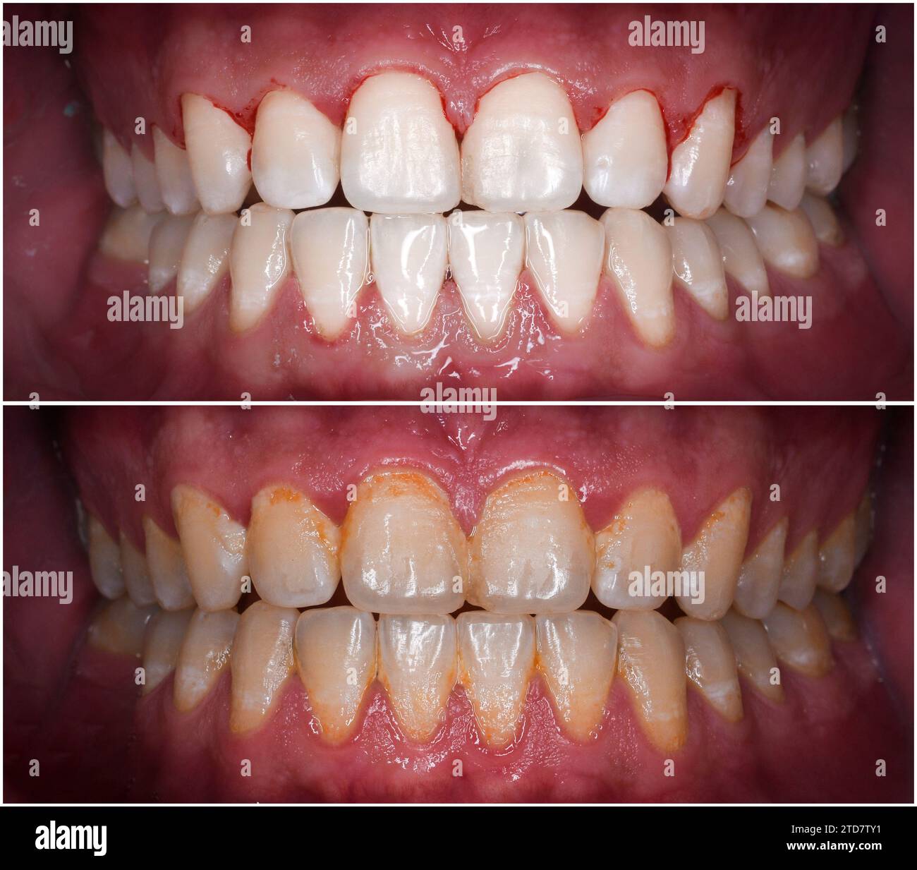 teeth tartar and calculus cleaning Stock Photo - Alamy