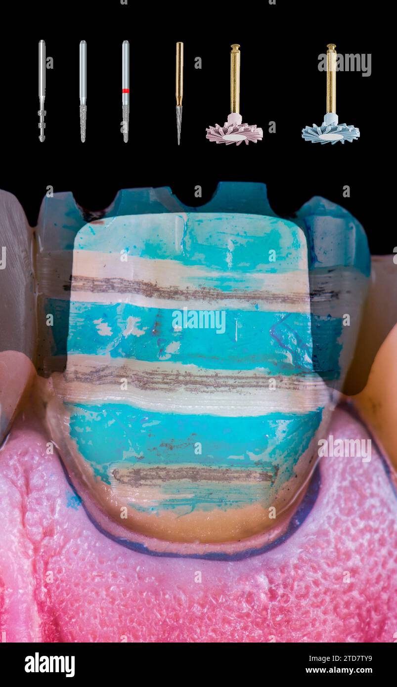 teeth guided preparation for full ceramic crown Stock Photo - Alamy