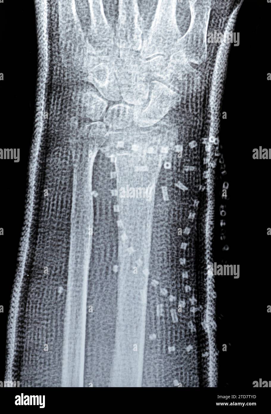 Colles fracture healing of an old female, a type of fracture of the ...