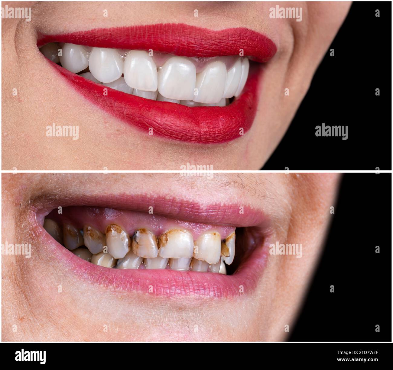 before and after picture of dental ceramic restoration on teeth and ...