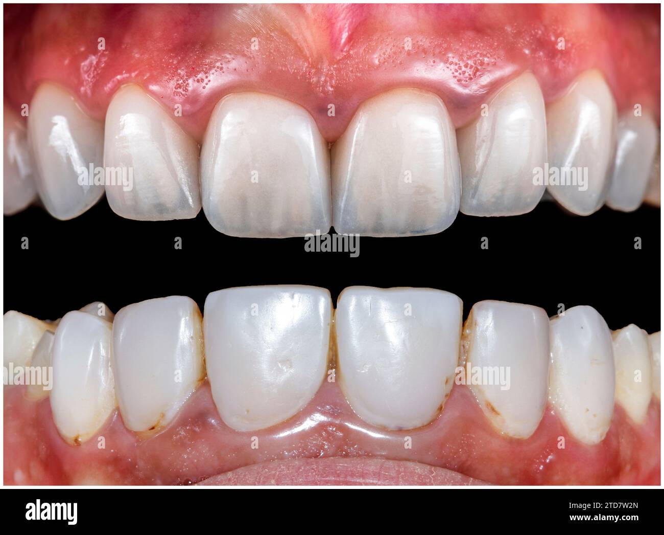 Disadvantage Of Dental Porcelain Restoration at Sally Hyland blog