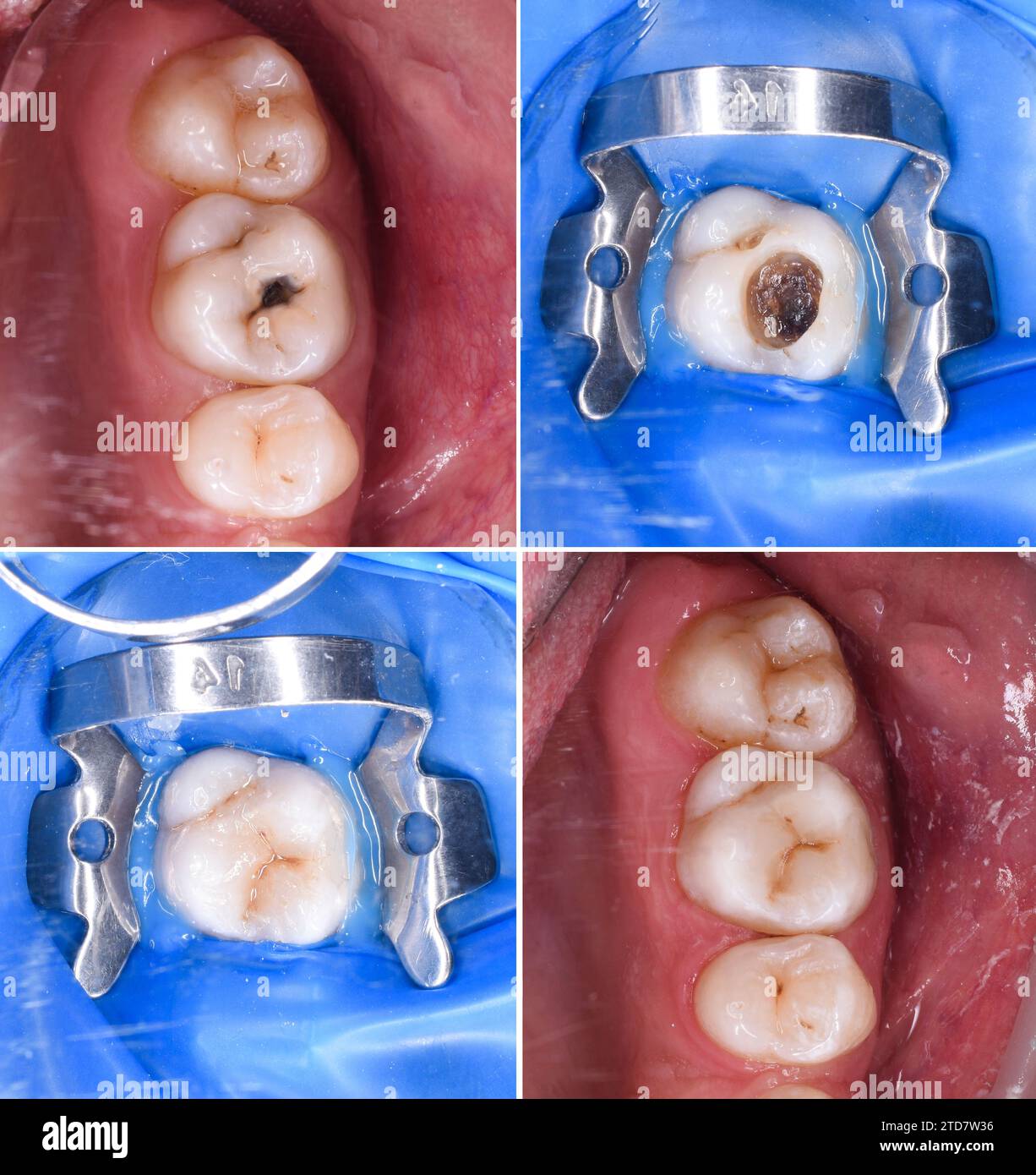 before and after picture of dental ceramic restoration on teeth and ...