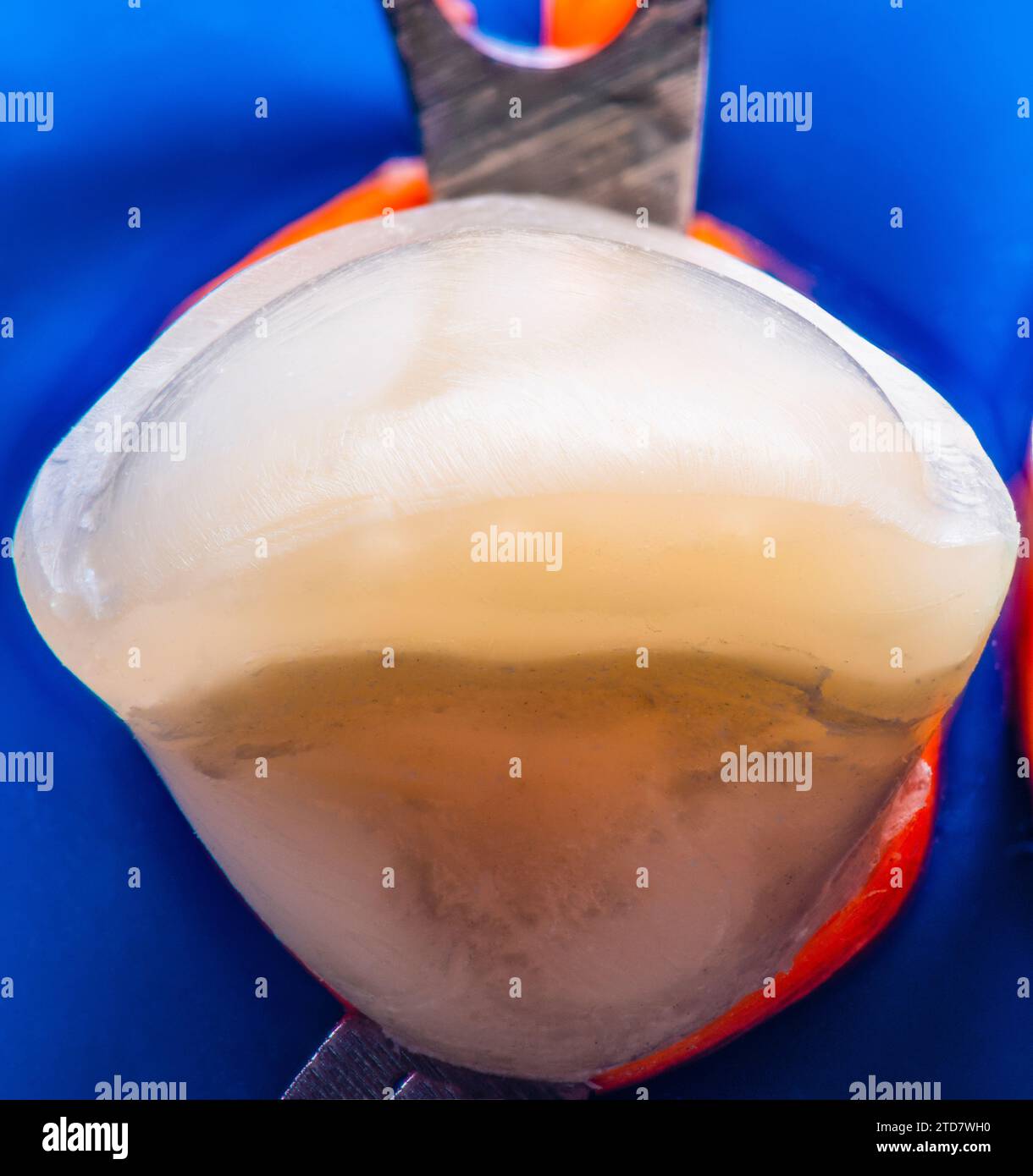 Tooth preparation hi-res stock photography and images - Alamy