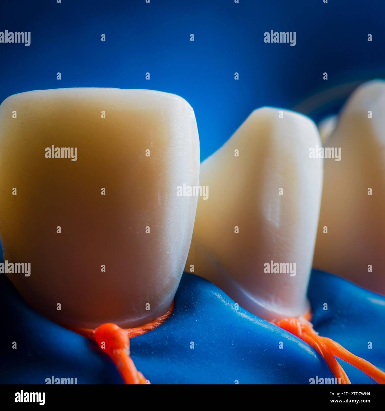 tooth minimal veneer preparation Stock Photo - Alamy