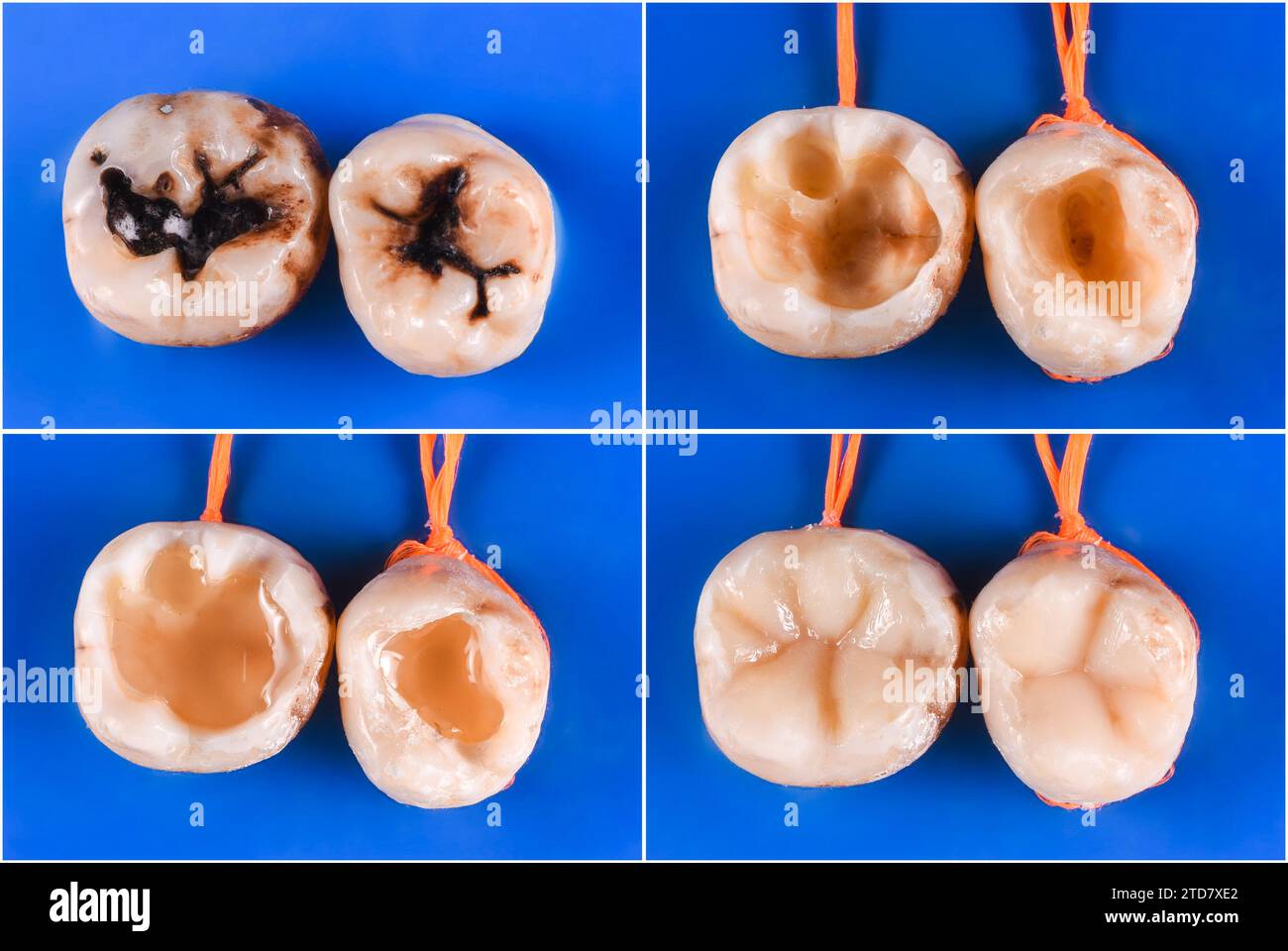 Dental prosthetic restoration Cut Out Stock Images & Pictures - Alamy
