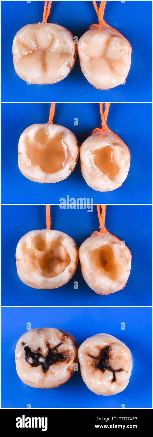 Prosthetic restoration hi-res stock photography and images - Alamy