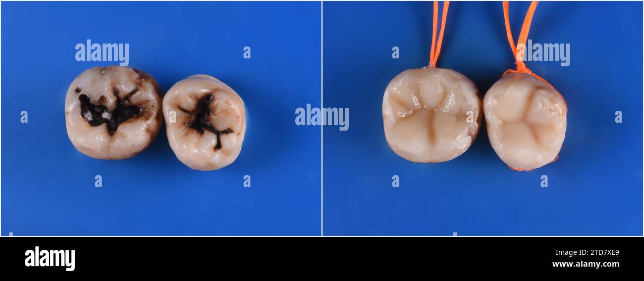 tooth restoration with composite filling Stock Photo - Alamy