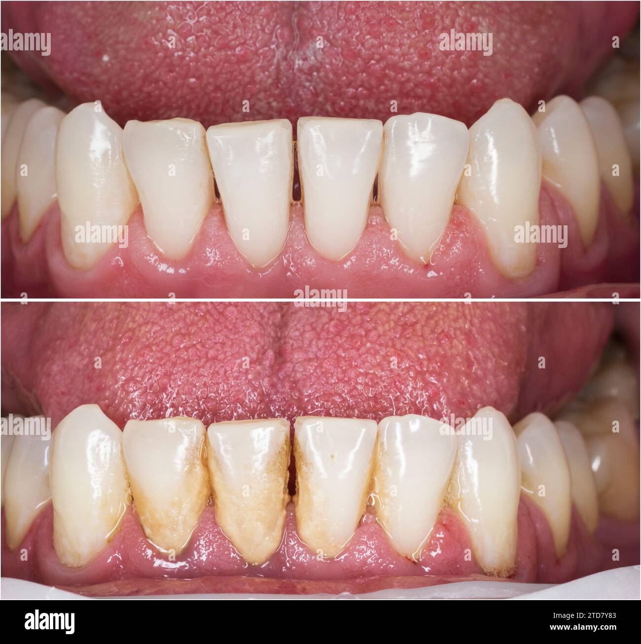 teeth tartar and calculus deep cleaning Stock Photo - Alamy