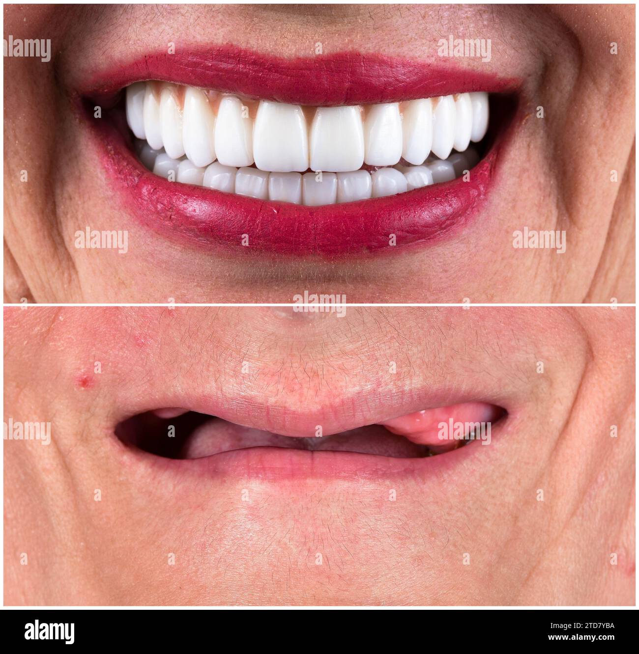 full mouth restoration by implants and zircon bridge Stock Photo - Alamy