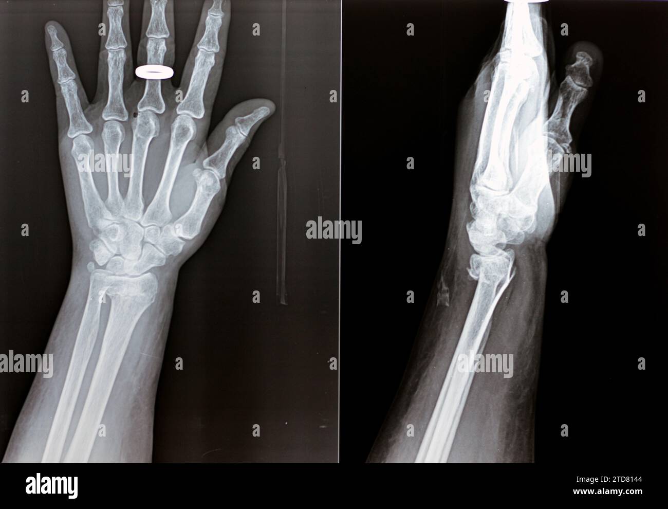 Colles' fracture of an old female, a type of fracture of the distal ...