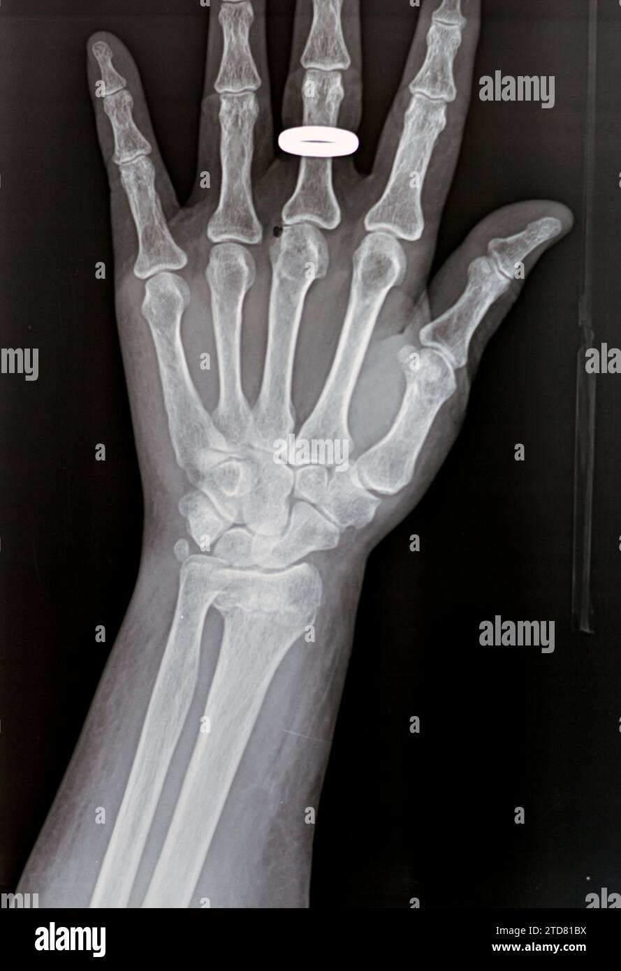 Colles' fracture of an old female, a type of fracture of the distal ...