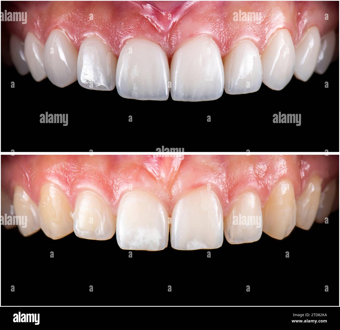 ceramic crowns and veneers Stock Photo - Alamy