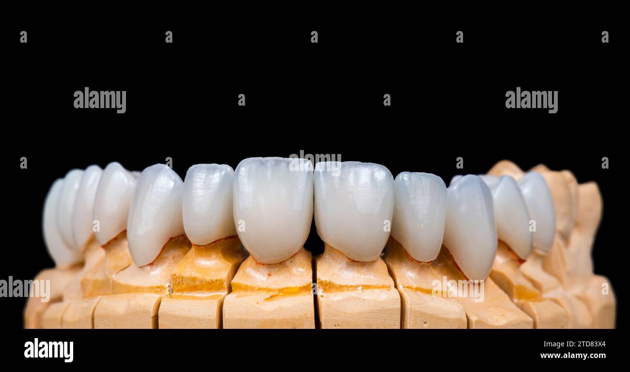 emax crowns and veneers natural color Stock Photo - Alamy