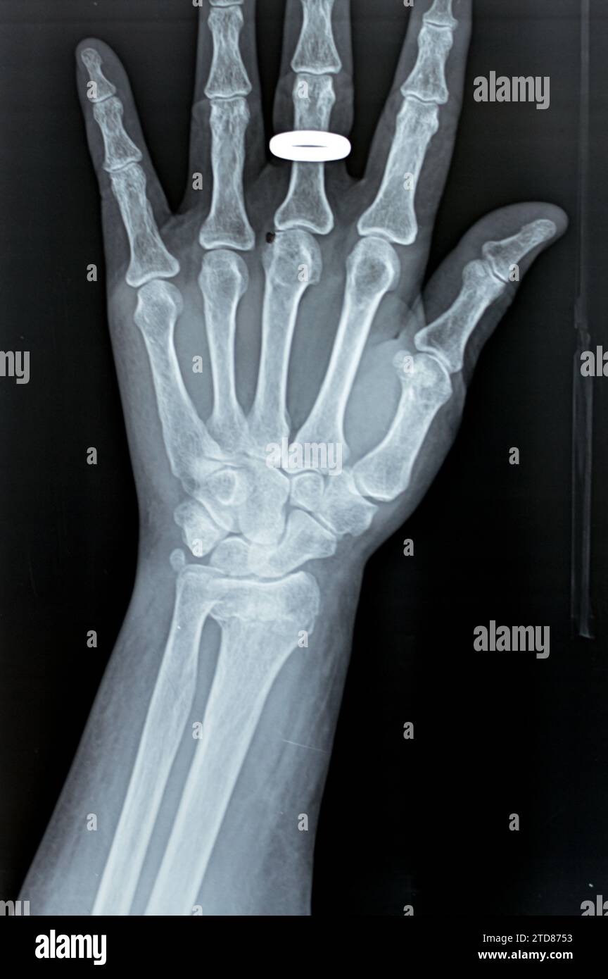 Colles' fracture of an old female, a type of fracture of the distal ...