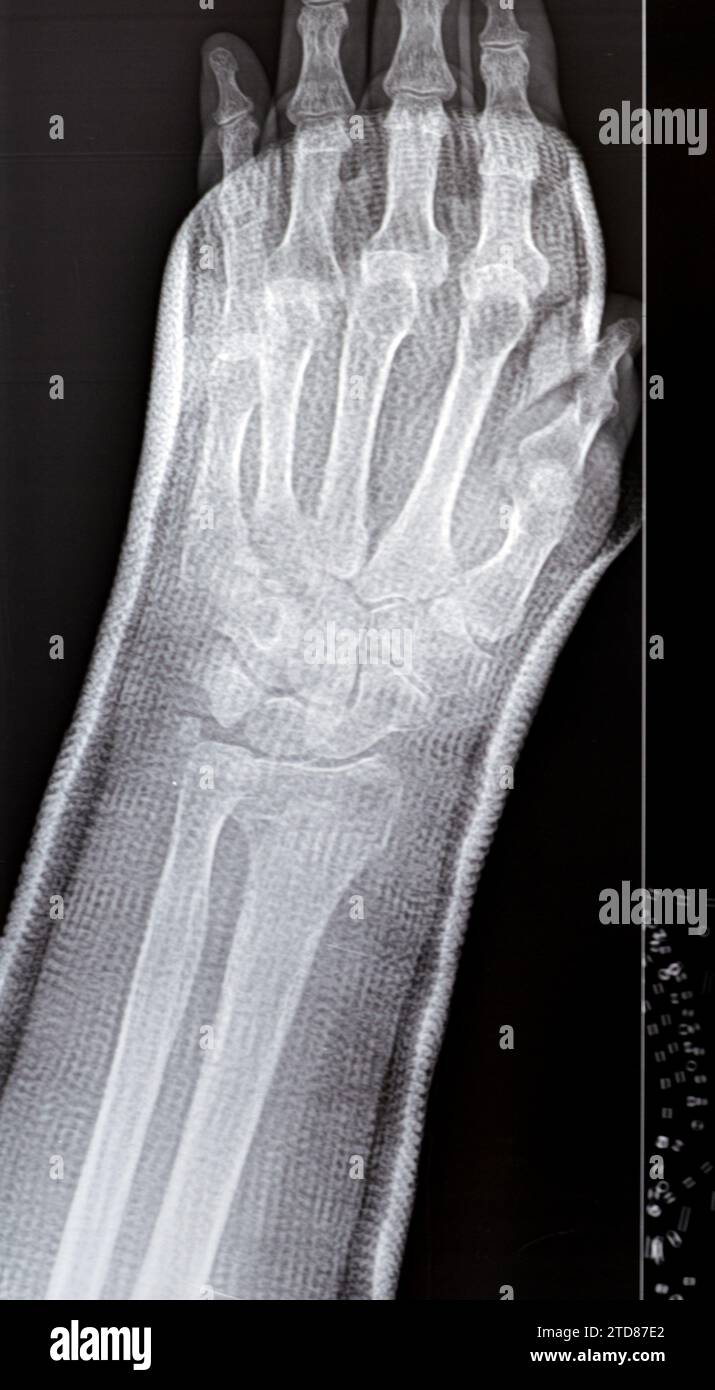 Colles fracture reduction of an old female, a type of fracture of the ...