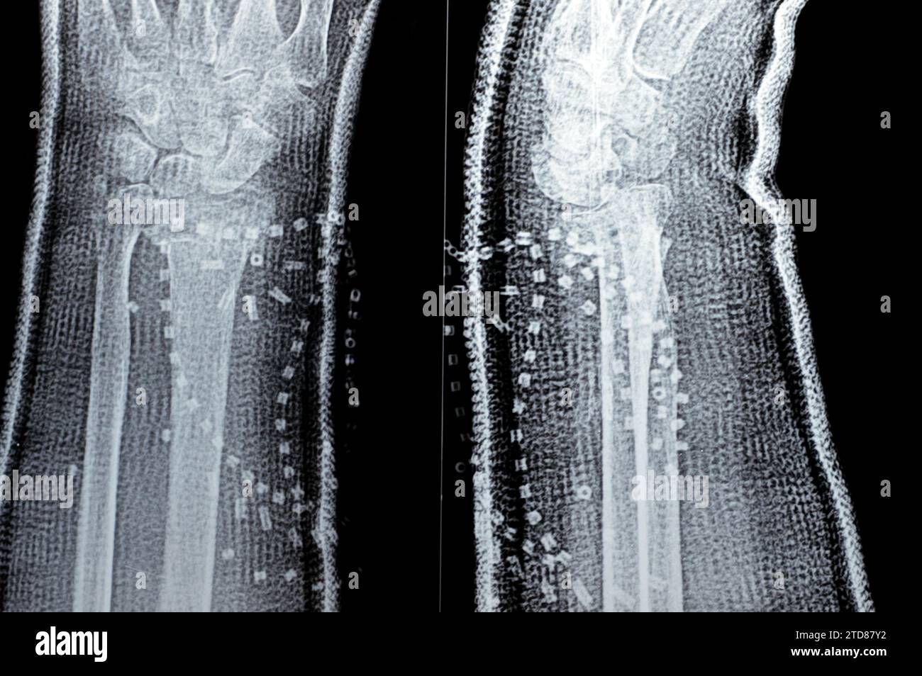 Colles fracture healing of an old female, a type of fracture of the ...