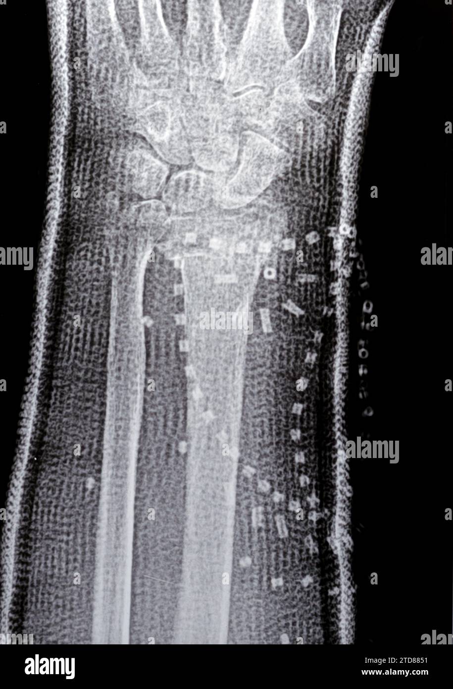 Colles fracture healing of an old female, a type of fracture of the ...