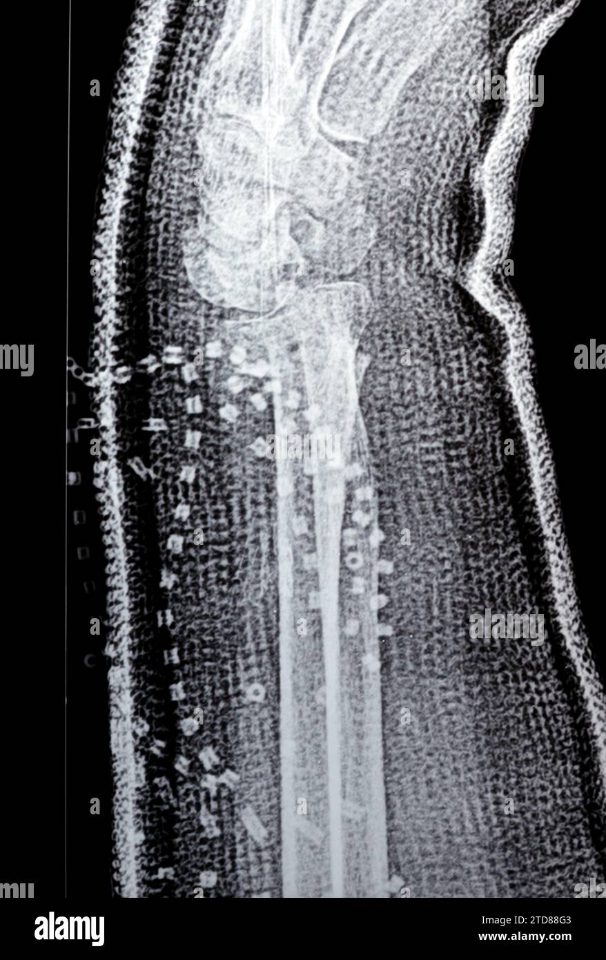 Colles fracture healing of an old female, a type of fracture of the ...