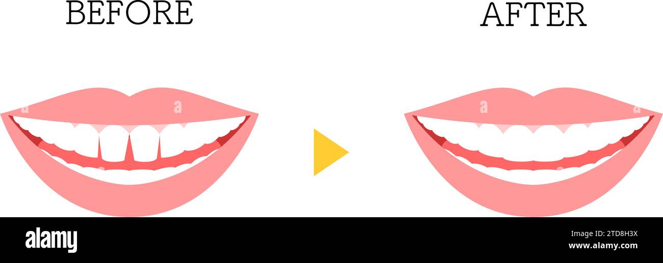 Cosmetic Dentistry, Direct Bonding Before and After, Gapped Anterior ...