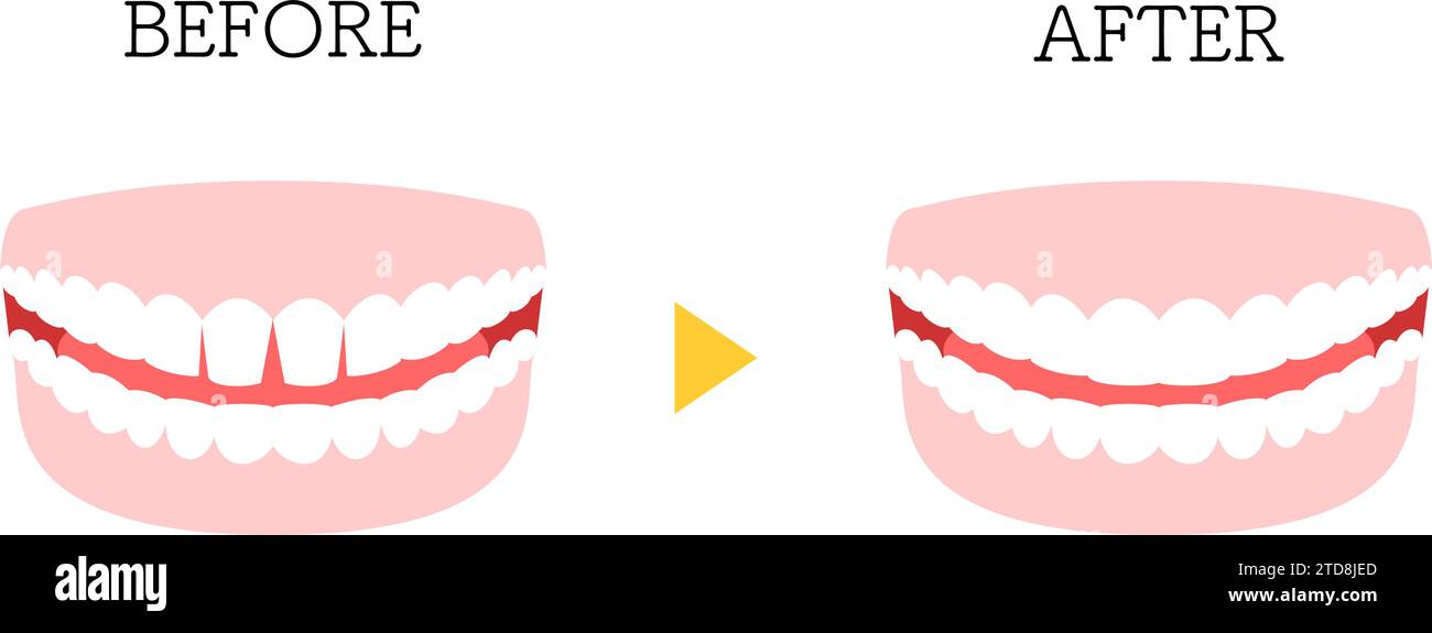 Cosmetic Dentistry, Direct Bonding Before and After, Gapped Anterior ...
