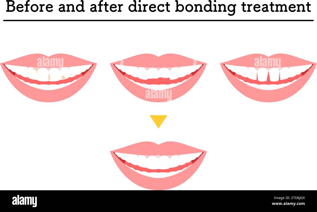 Cosmetic dentistry: treatment with direct bonding, decayed or chipped ...