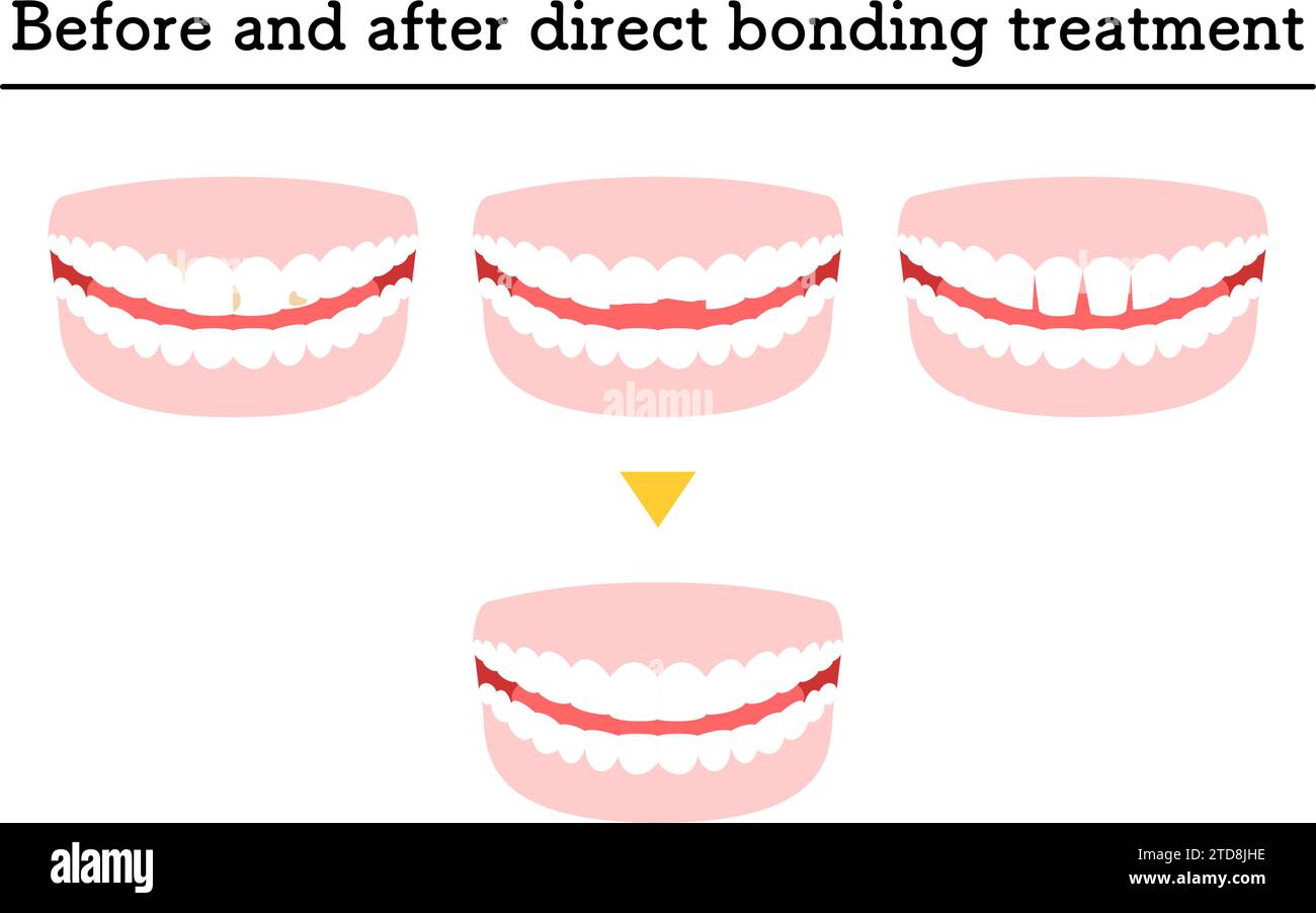Cosmetic dentistry: treatment with direct bonding, decayed or chipped ...
