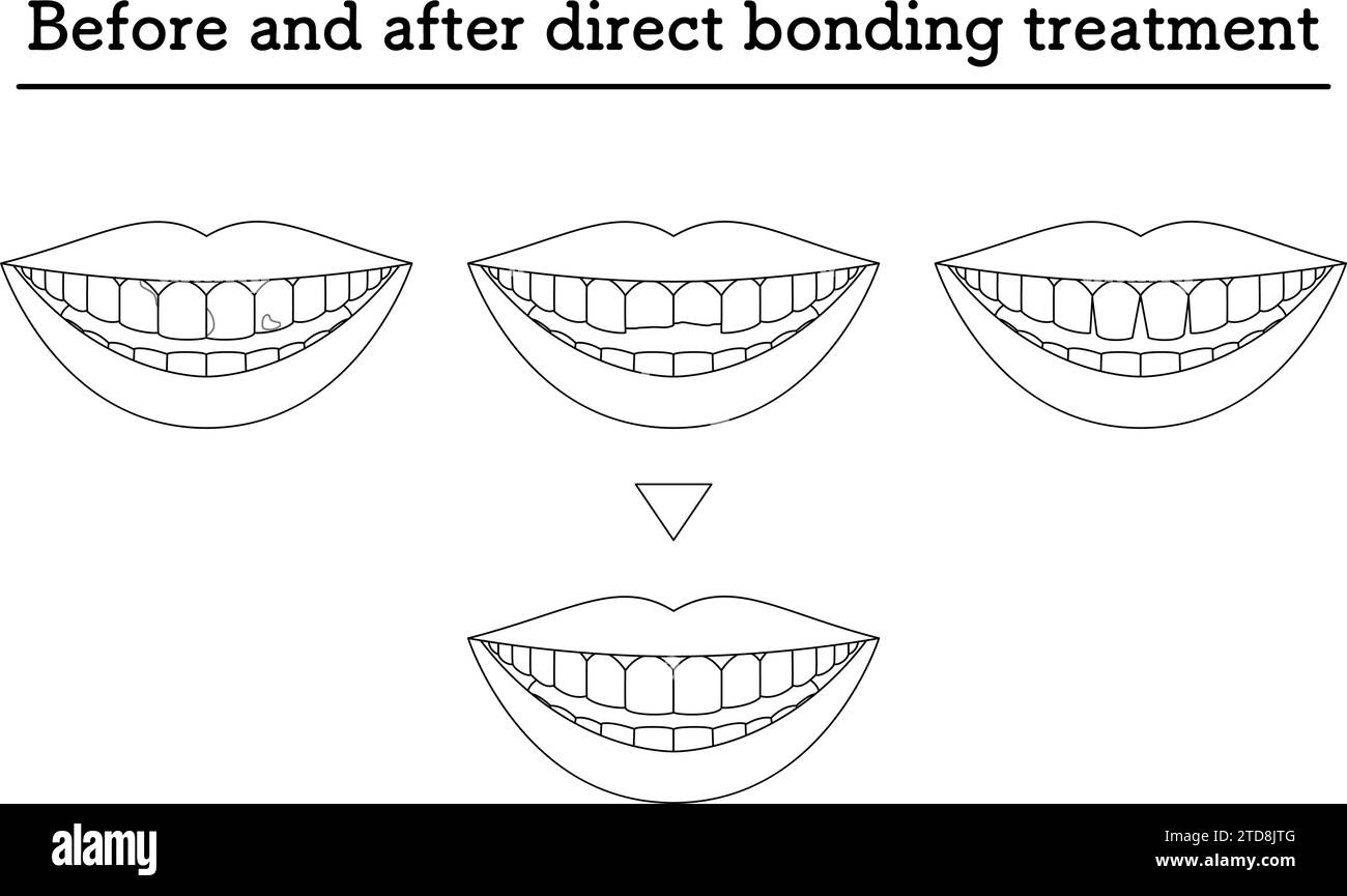 Cosmetic dentistry: treatment with direct bonding, decayed or chipped teeth, and gaps, Vector ...