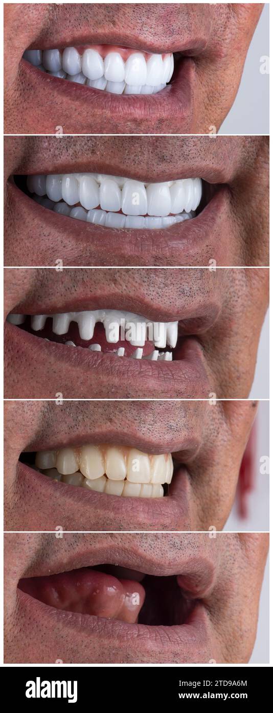 zircon bridge restoration on implants Stock Photo - Alamy