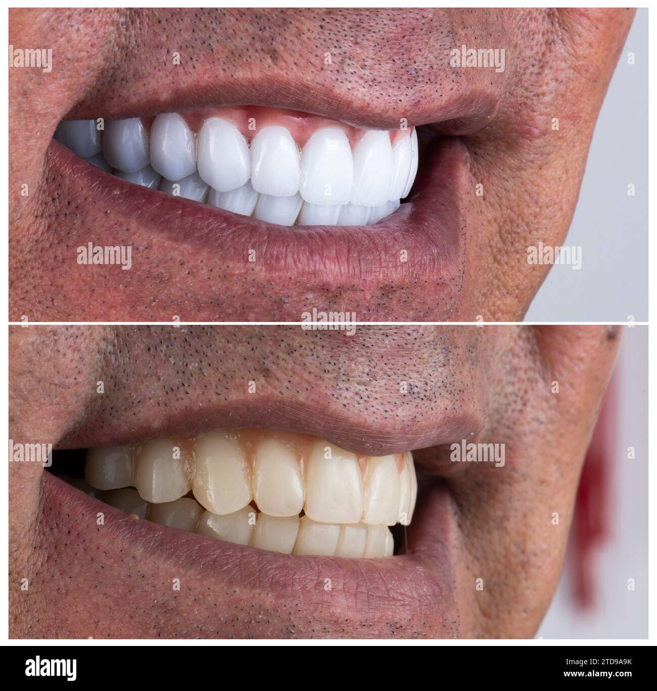 zircon bridge restoration on implants Stock Photo - Alamy