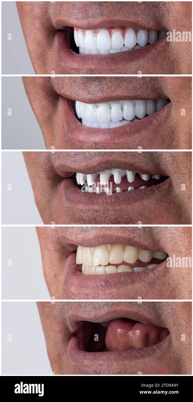 zircon bridge restoration on implants Stock Photo - Alamy