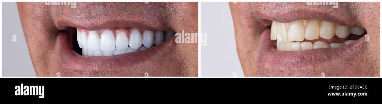 zircon bridge restoration on implants Stock Photo - Alamy