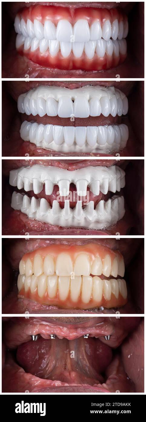 zircon bridge restoration on implants Stock Photo - Alamy