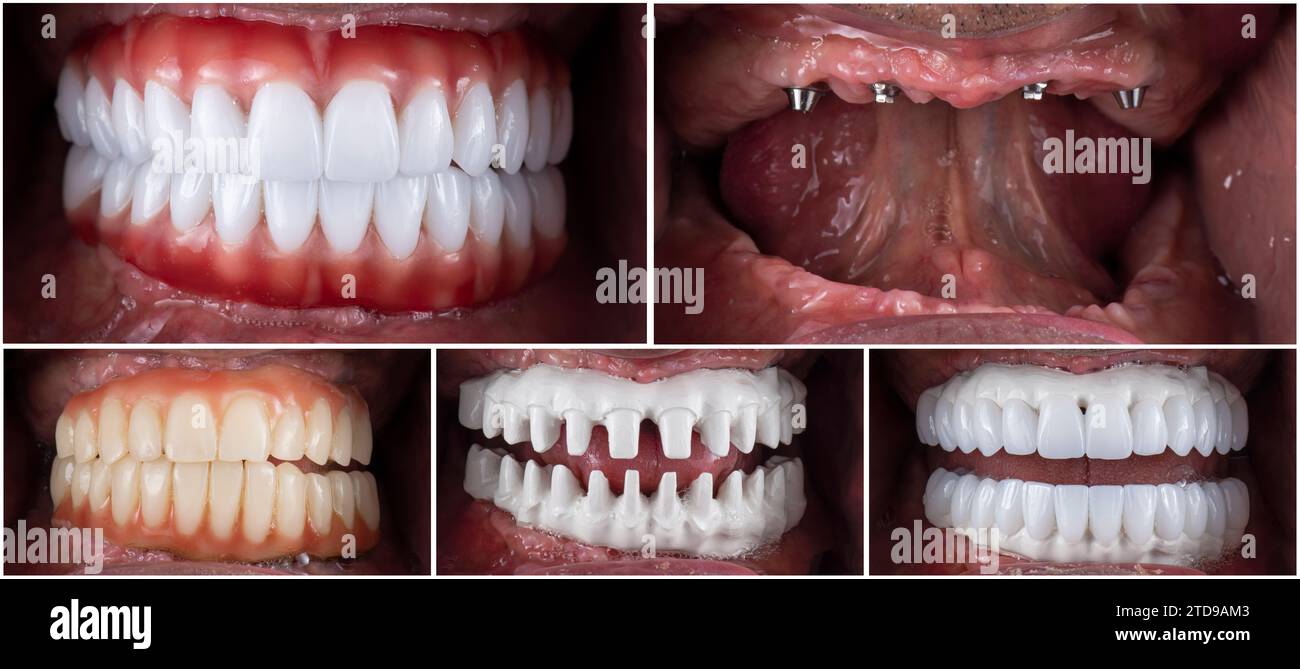 zircon bridge restoration on implants Stock Photo - Alamy