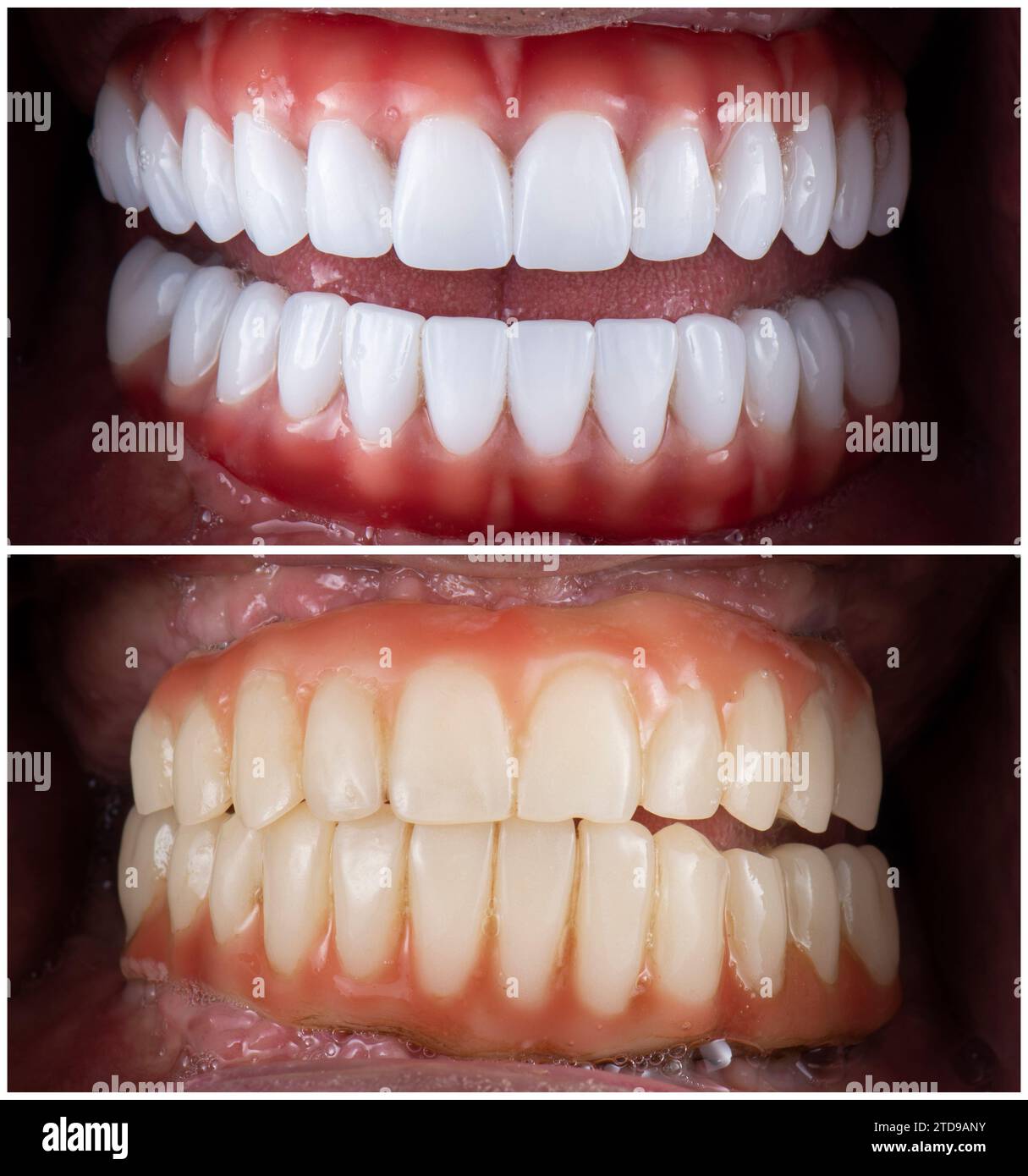 zircon bridge restoration on implants Stock Photo - Alamy