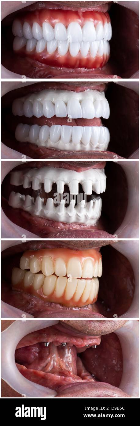 zircon bridge restoration on implants Stock Photo - Alamy