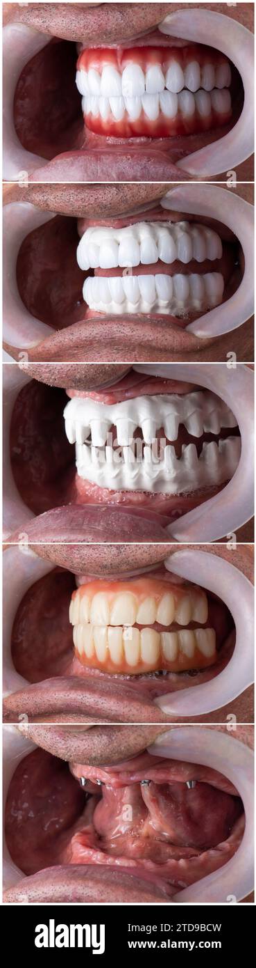 zircon bridge restoration on implants Stock Photo - Alamy