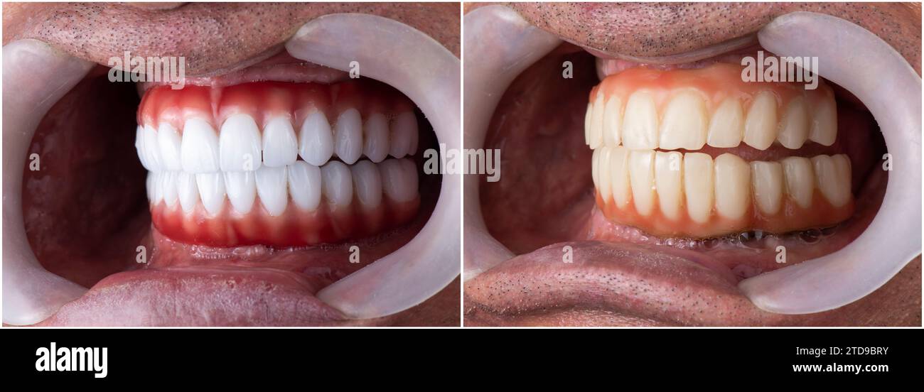 zircon bridge restoration on implants Stock Photo - Alamy