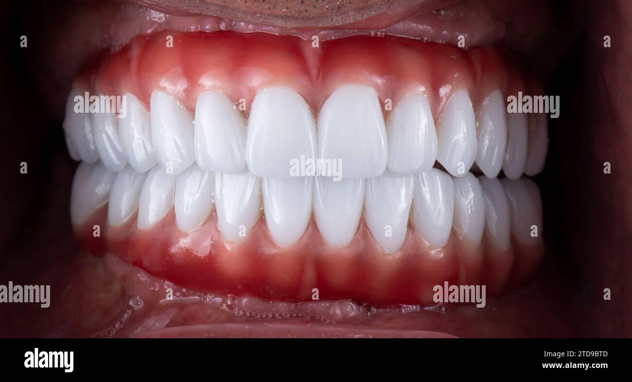 zircon bridge restoration on implants Stock Photo - Alamy