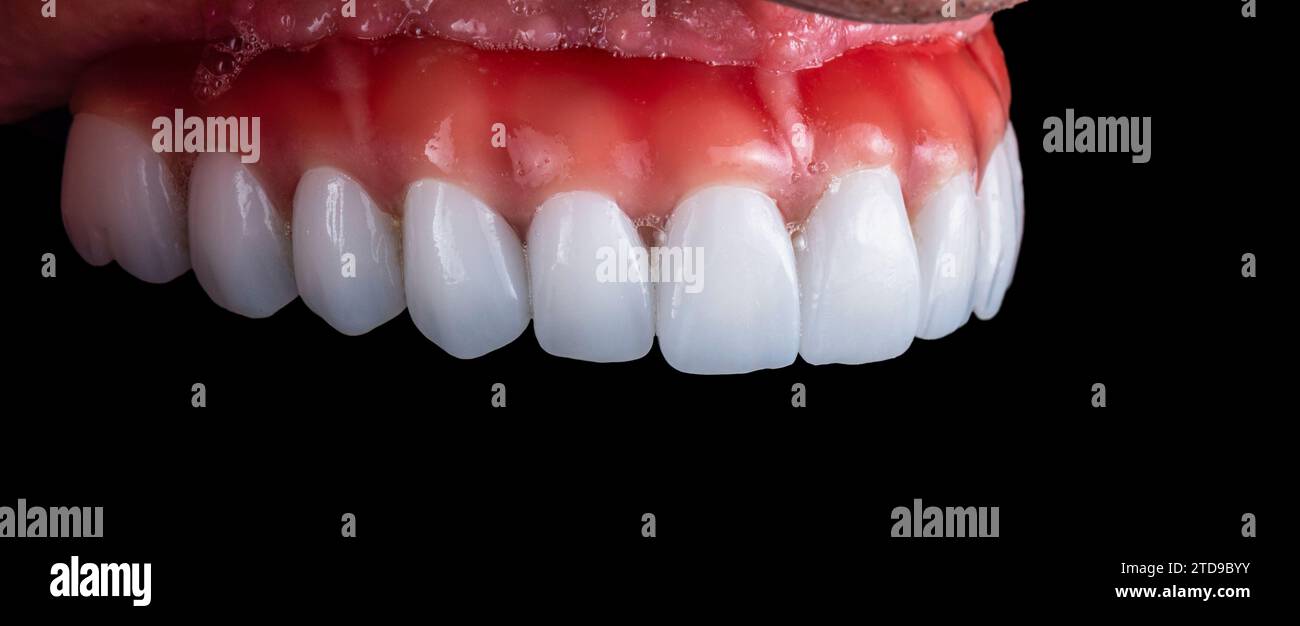 zircon bridge restoration on implants Stock Photo - Alamy