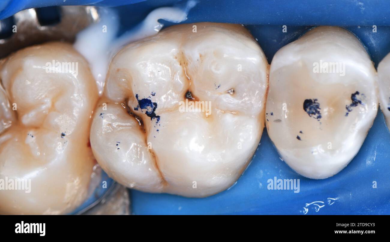 caries treatment by dental direct filling restoration Stock Photo - Alamy