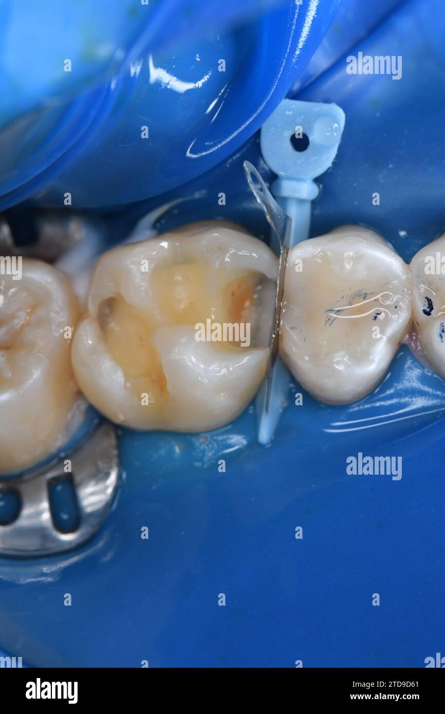 caries treatment by dental direct filling restoration Stock Photo - Alamy