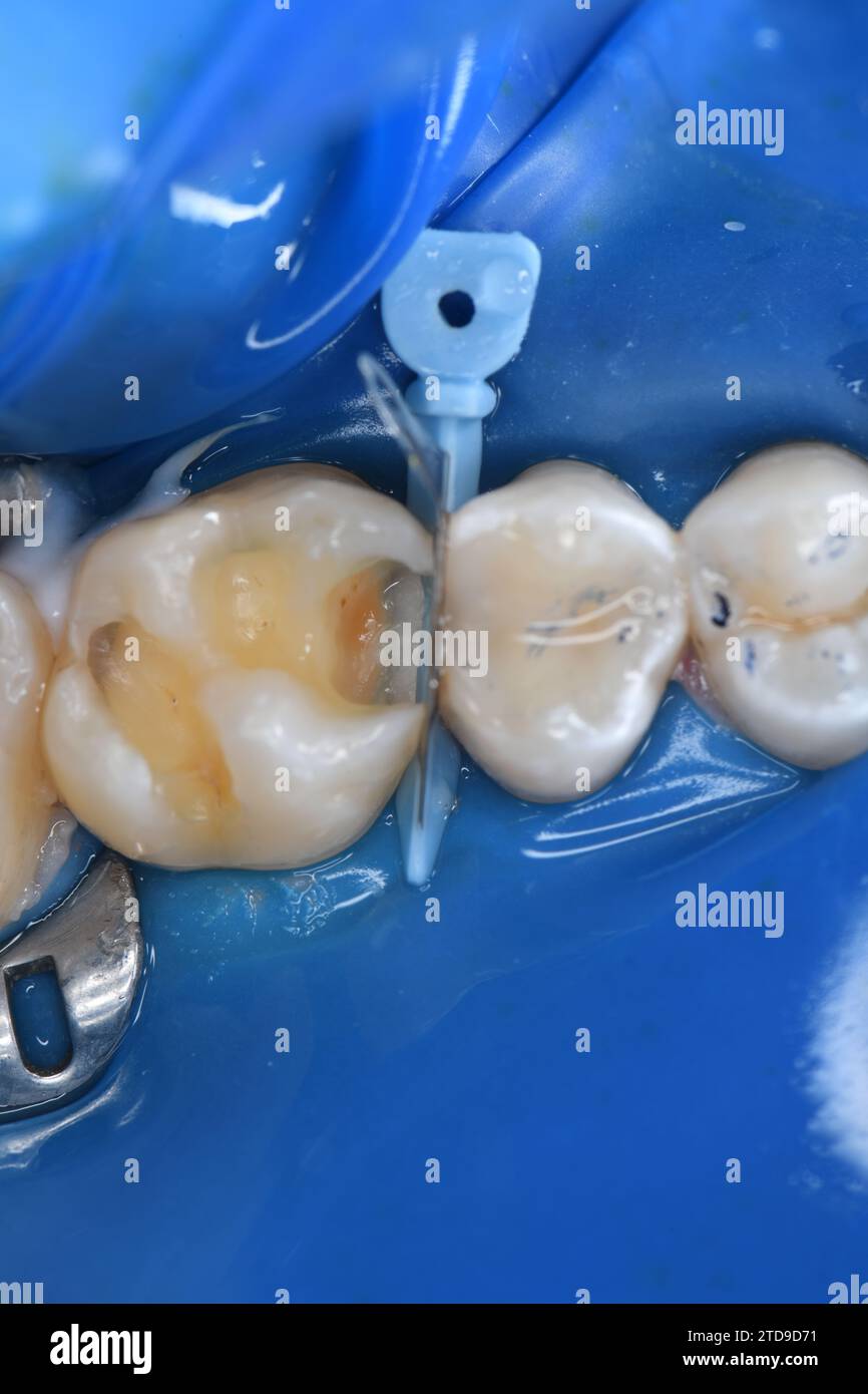 caries treatment by dental direct filling restoration Stock Photo - Alamy