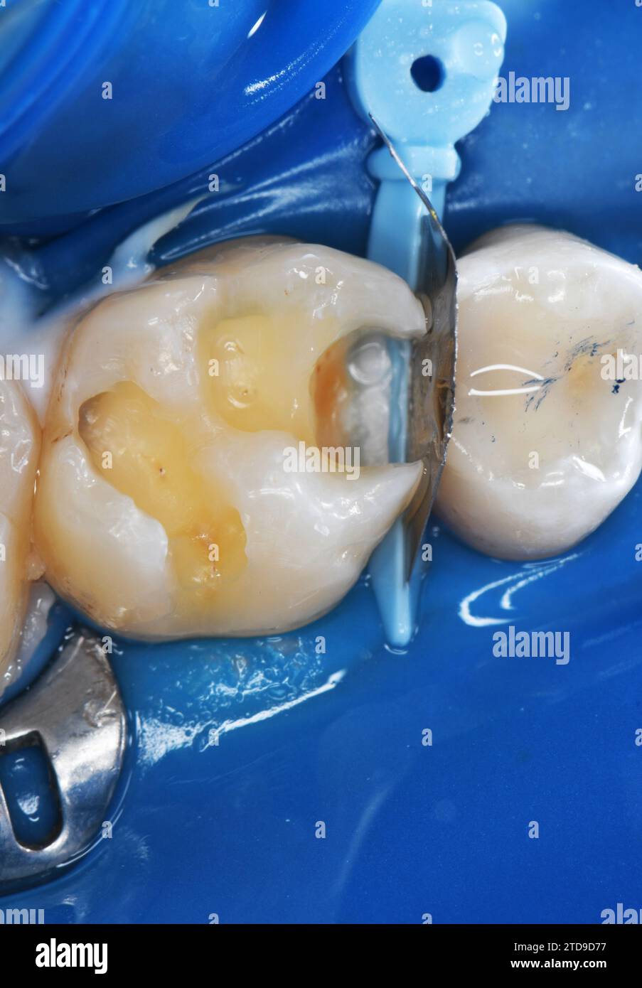 caries treatment by dental direct filling restoration Stock Photo - Alamy