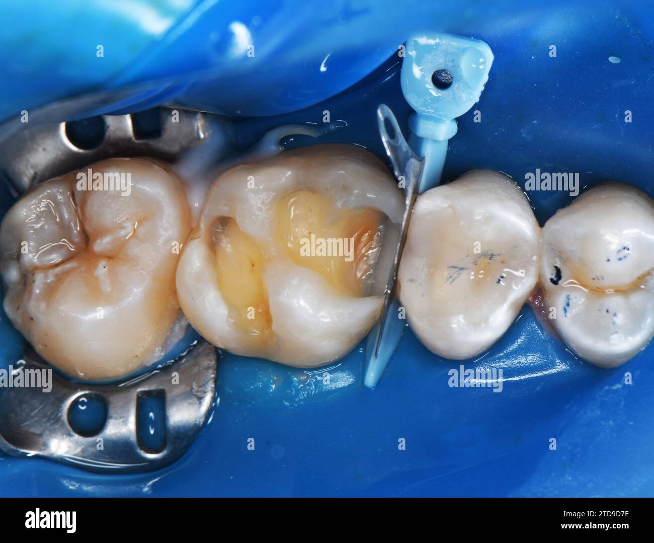 caries treatment by dental direct filling restoration Stock Photo - Alamy