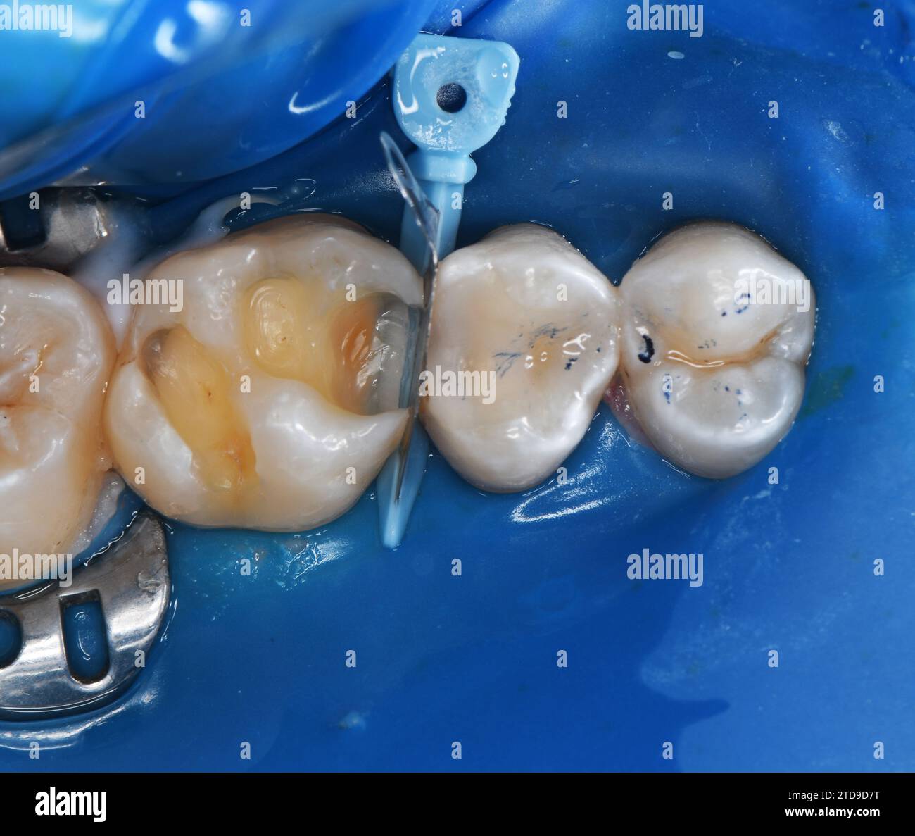 caries treatment by dental direct filling restoration Stock Photo - Alamy