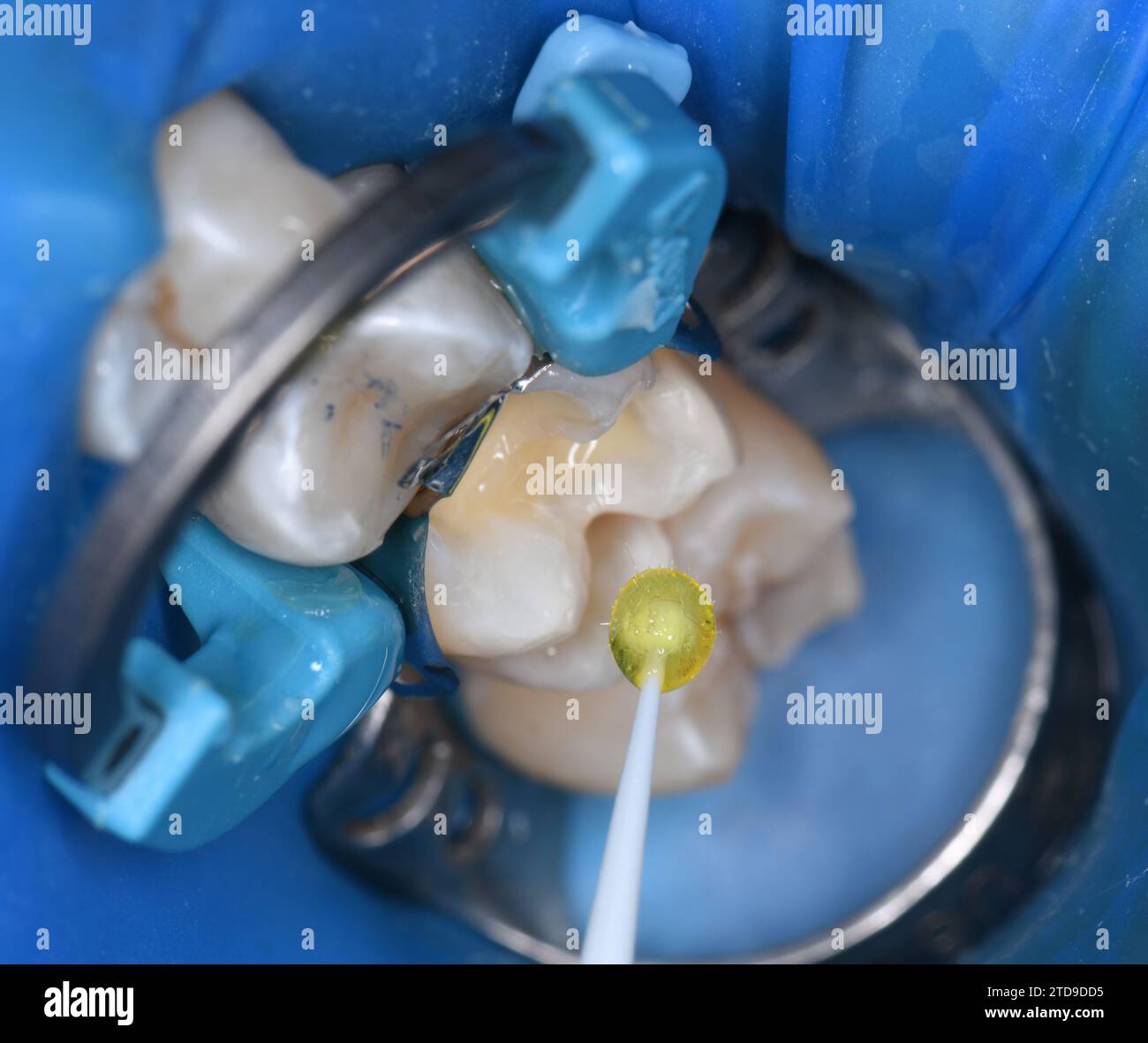 caries treatment by dental direct filling restoration Stock Photo - Alamy