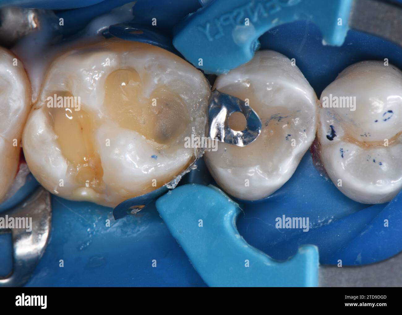 caries treatment by dental direct filling restoration Stock Photo - Alamy
