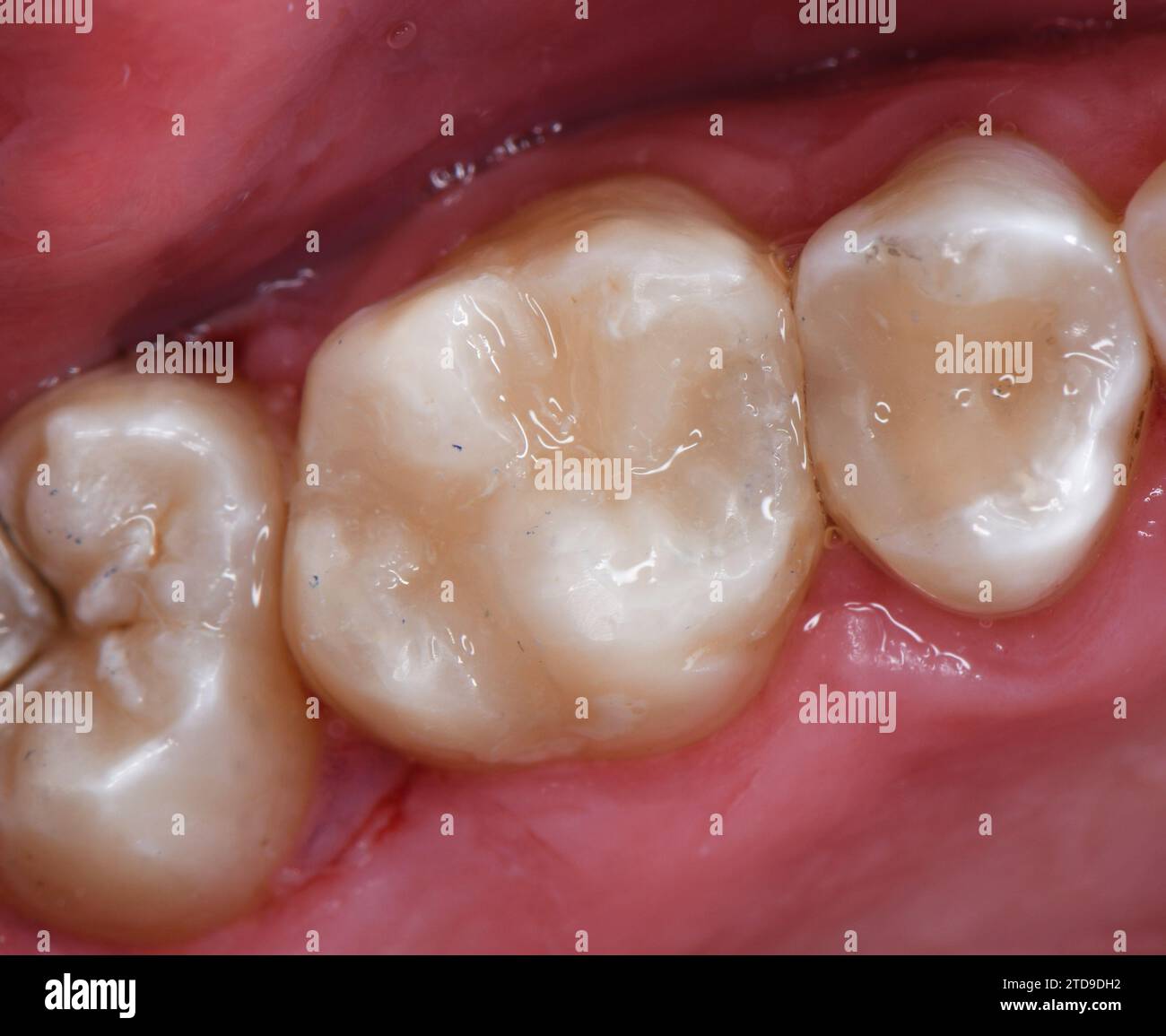 caries treatment by dental direct filling restoration Stock Photo - Alamy