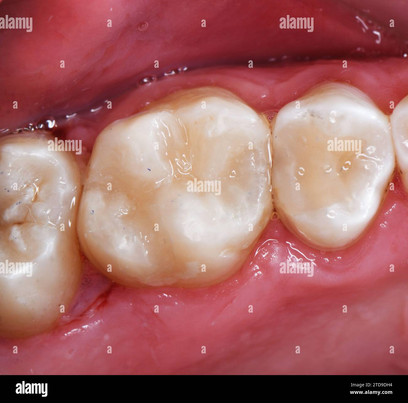 caries treatment by dental direct filling restoration Stock Photo - Alamy
