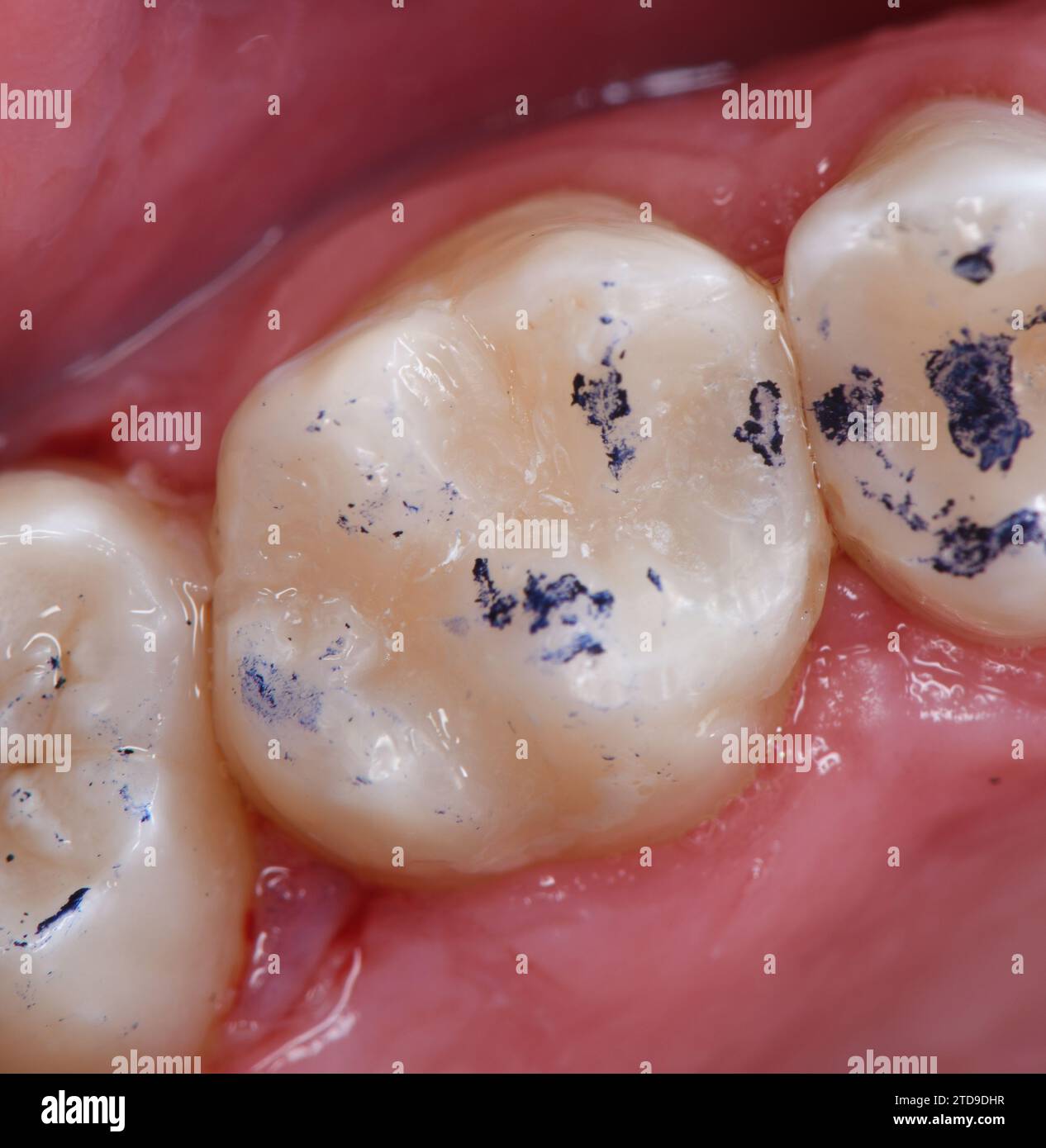 caries treatment by dental direct filling restoration Stock Photo - Alamy